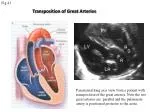 PPT - Transposition of The Great Arteries PowerPoint Presentation, free ...