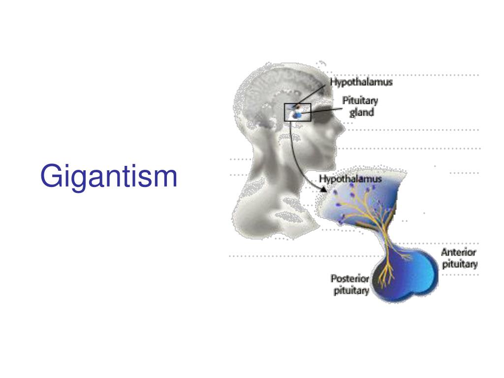 PPT - Gigantism PowerPoint Presentation, free download - ID:3042392