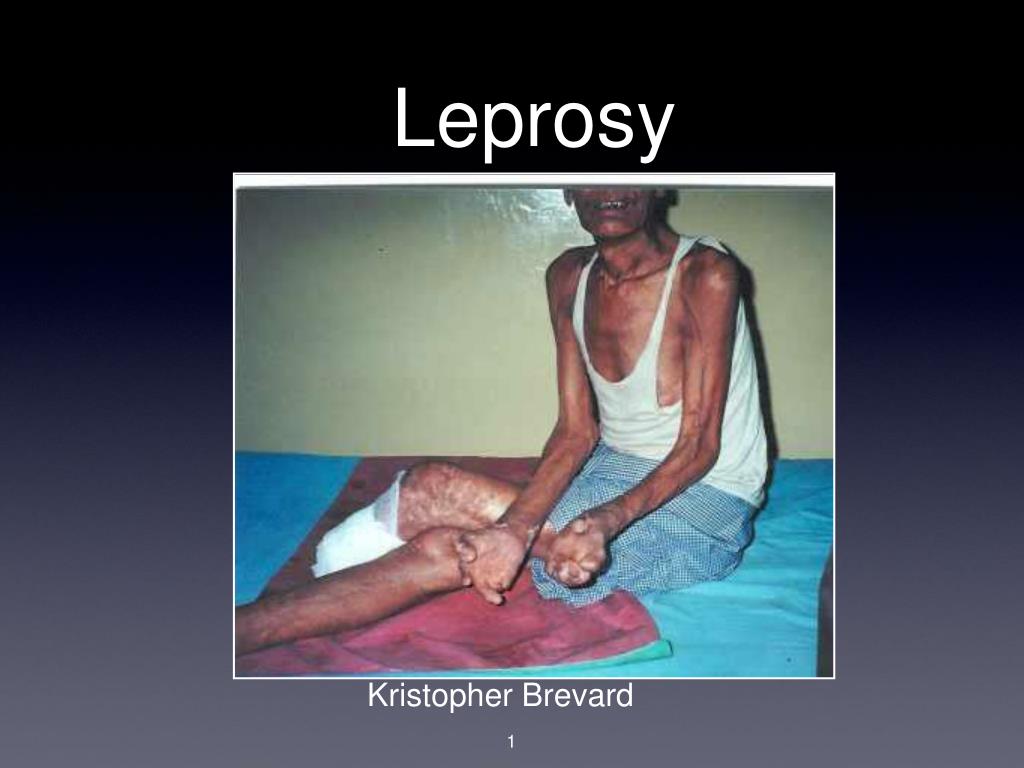 PPT - Leprosy PowerPoint Presentation, free download - ID:3060390