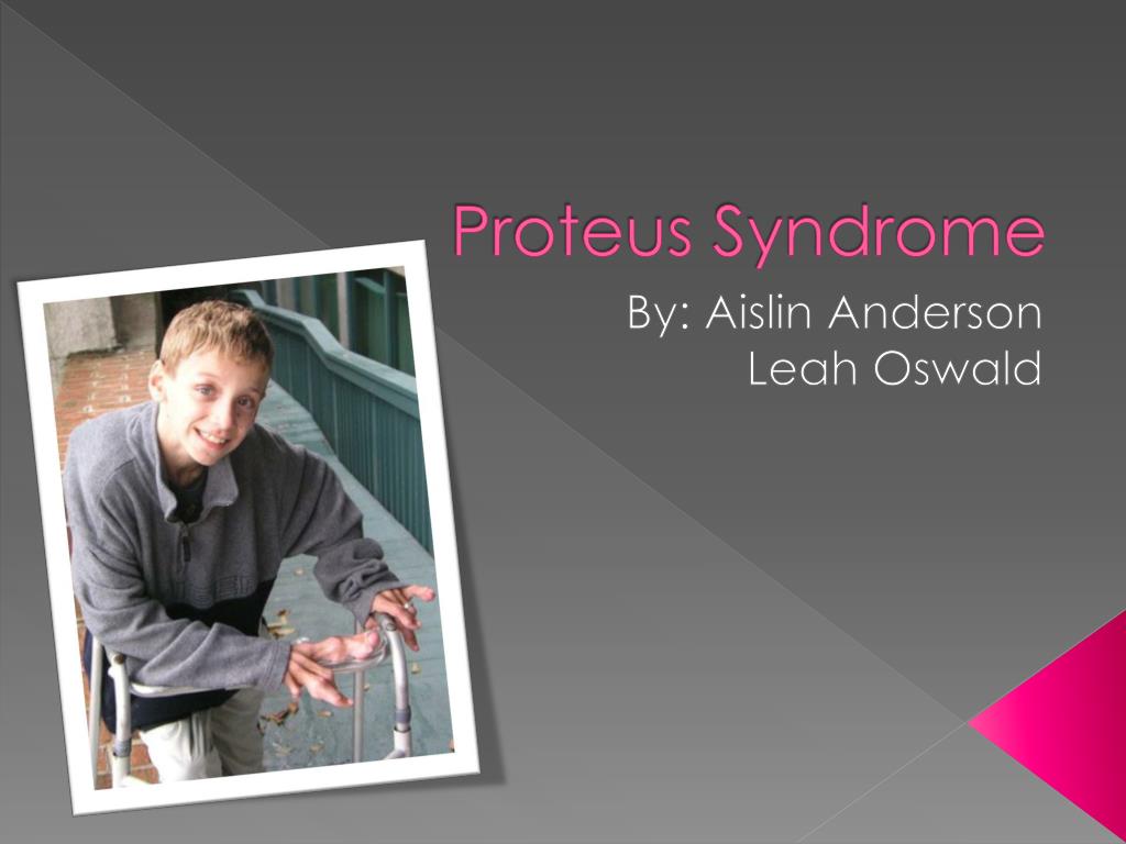 PPT - Proteus Syndrome PowerPoint Presentation, free download - ID:3062719