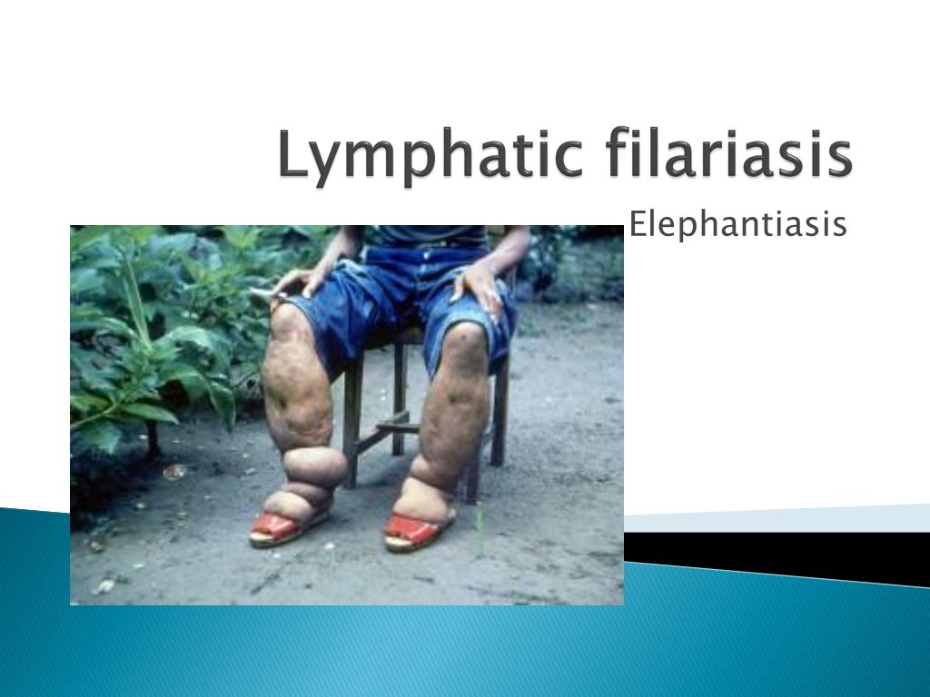 PPT - Lymphatic filariasis PowerPoint Presentation, free download - ID ...