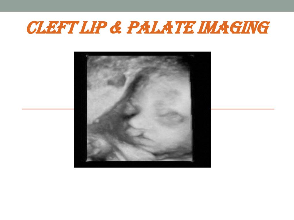 PPT - Cleft Lip & Palate imaging PowerPoint Presentation, free download ...