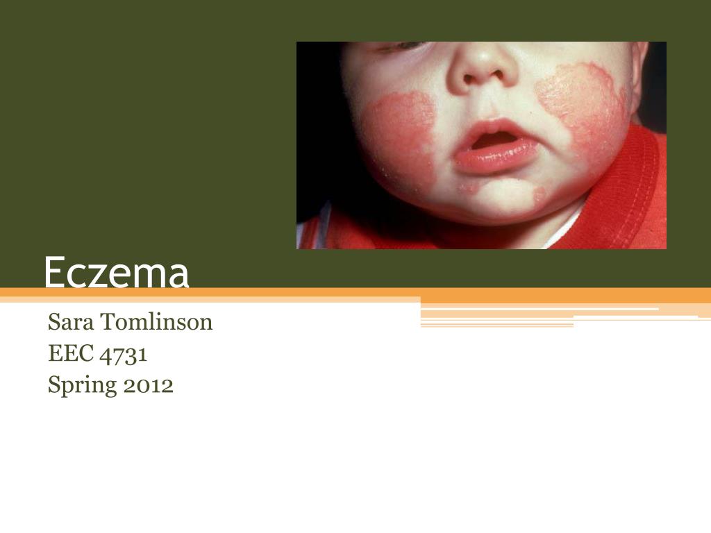PPT - Eczema PowerPoint Presentation, free download - ID:3151742