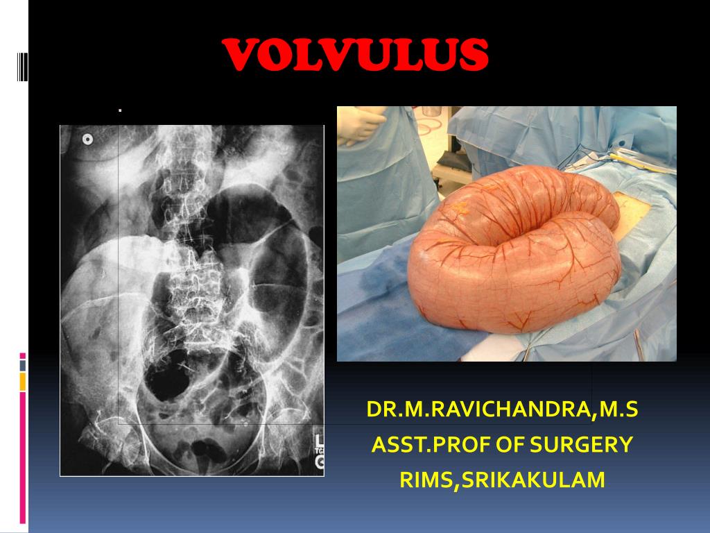 PPT - VOLVULUS PowerPoint Presentation, free download - ID:3343529