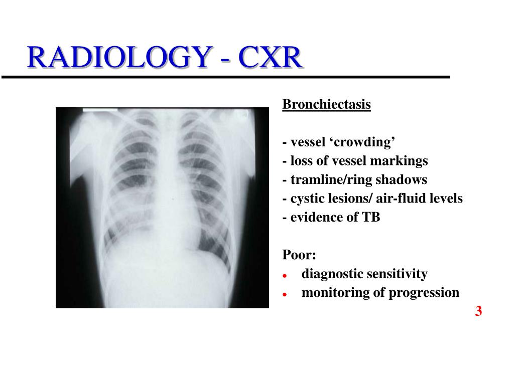 PPT - RADIOLOGY - CXR PowerPoint Presentation, free download - ID:3410806