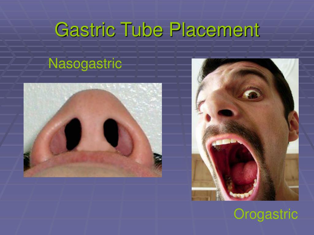 PPT - Gastric Tube Placement PowerPoint Presentation, free download ...