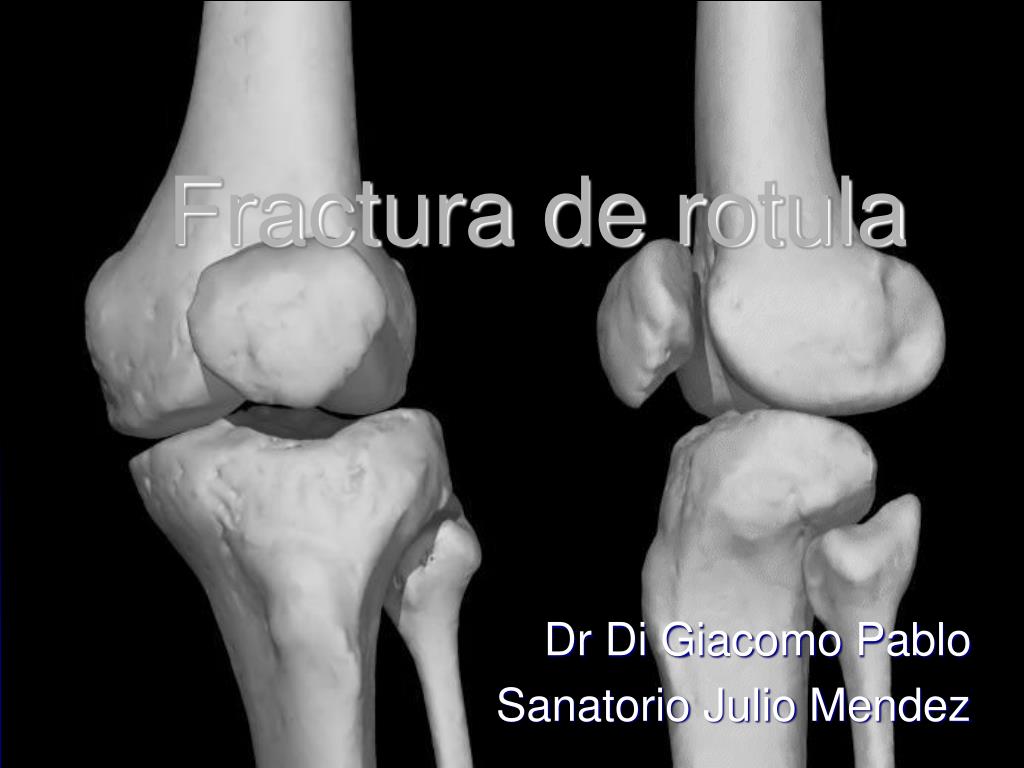 PPT - Fractura de rotula PowerPoint Presentation, free download - ID ...